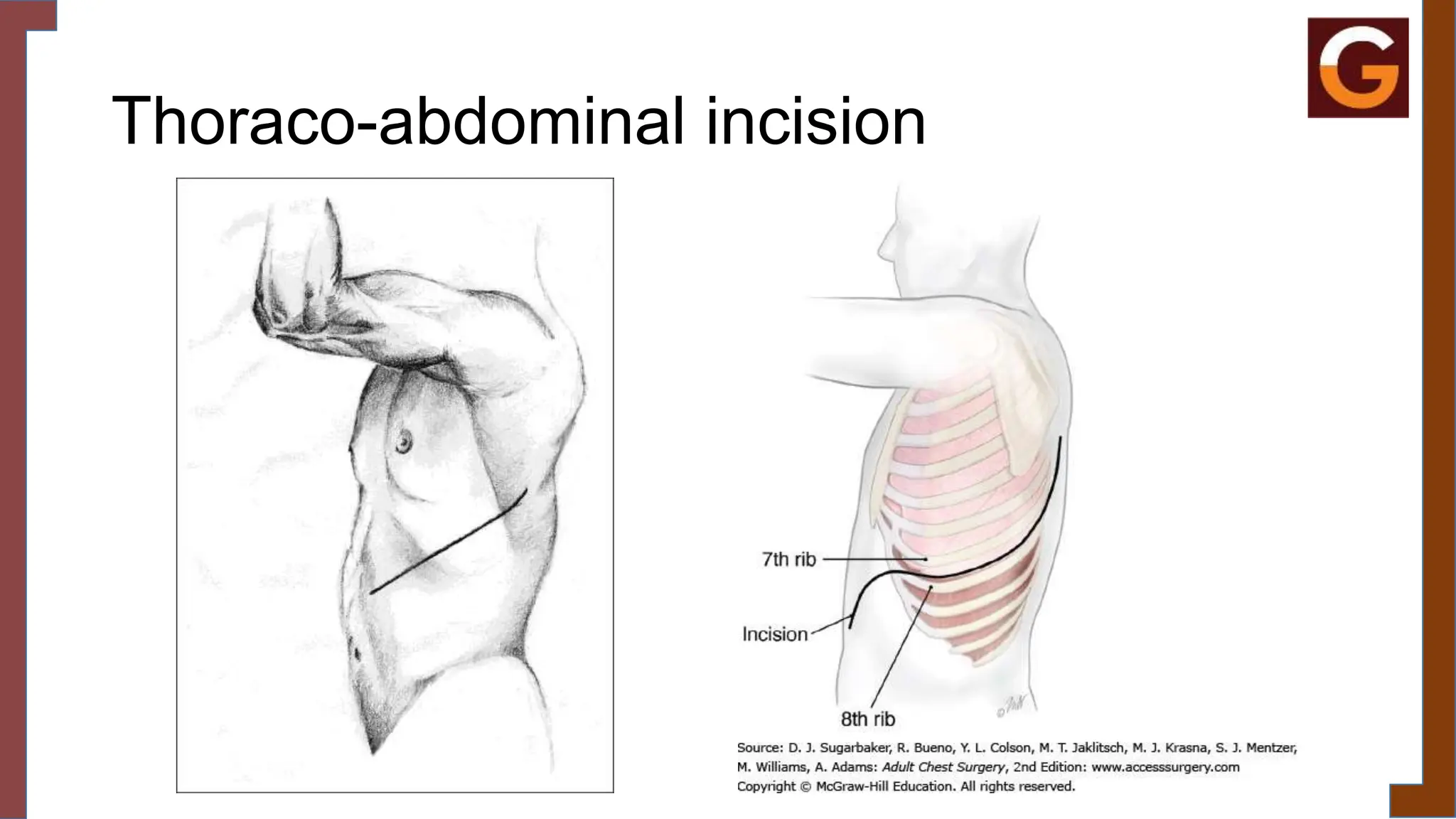 Types of abdominal surgeries and types of abdominal incisions.pptx