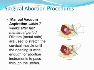Types of abortions | PPT