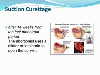 Laminaria Abortion