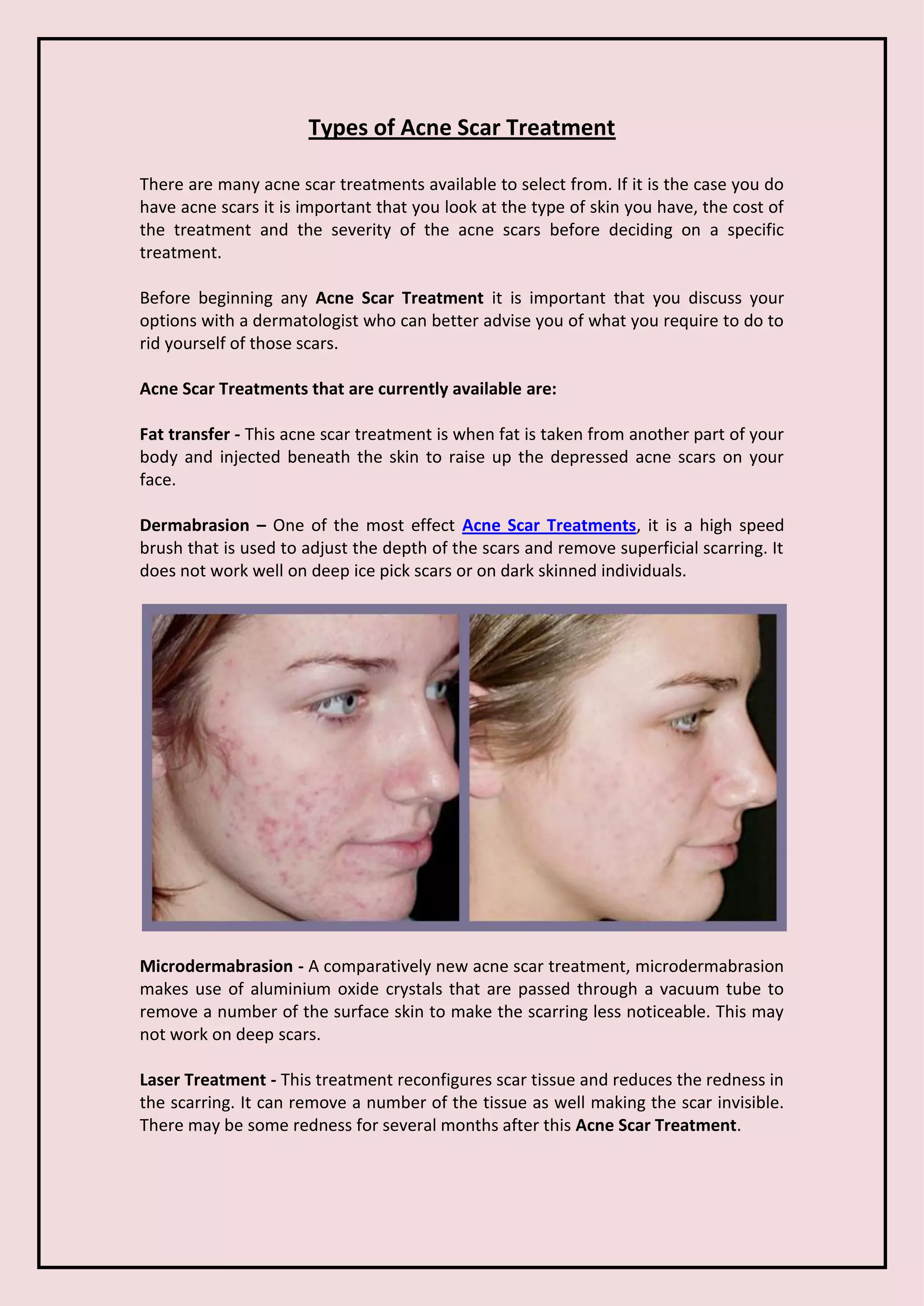 Types of Acne Scar Treatment | PDF