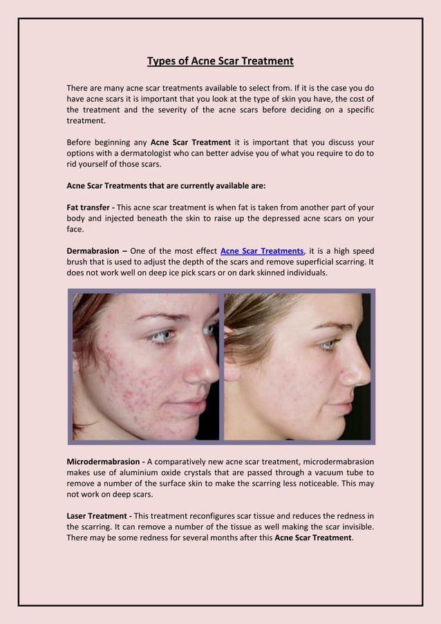 Types Of Acne Scar Treatment Pdf