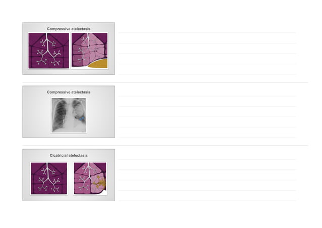 Types of atelectasis - Fact Sheet - ATF .pdf