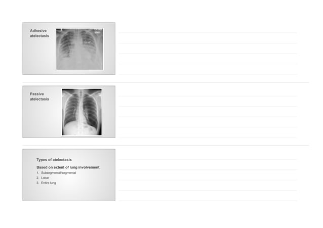 Types of atelectasis - Fact Sheet - ATF .pdf
