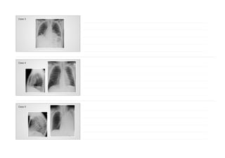 Types of atelectasis - Fact Sheet - ATF .pdf