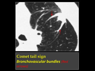 Types of atelectasis occupational lung disease-comet tail sign | PPT