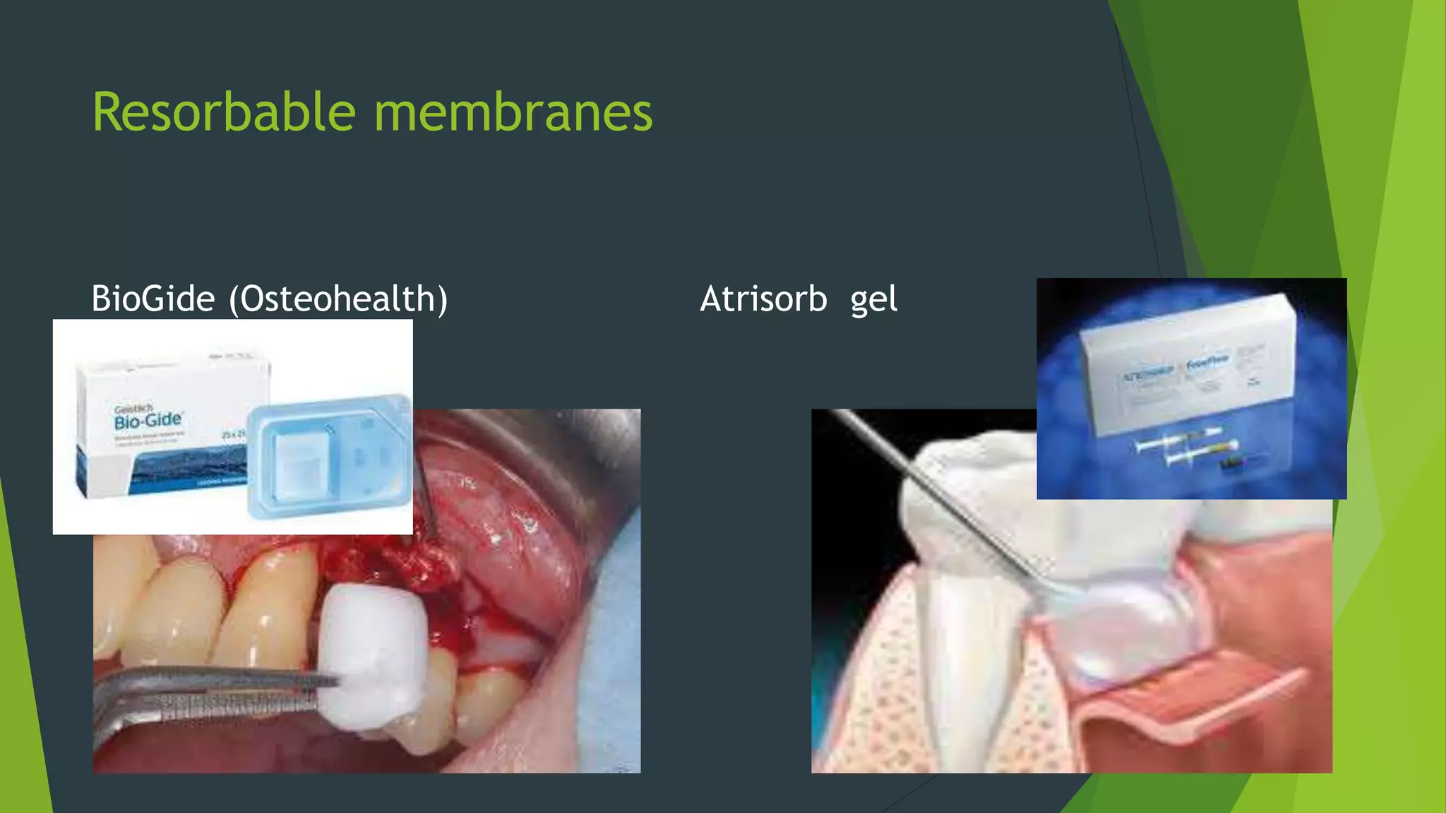 Types of bone and membrane used in guided tissue regeneration | PPTX