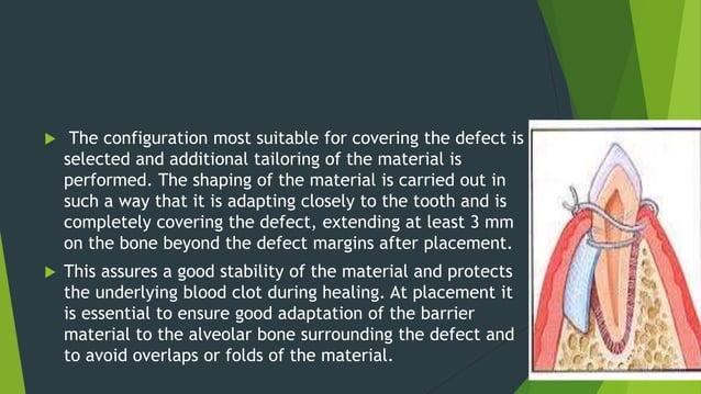 Types of bone and membrane used in guided tissue regeneration | PPTX ...