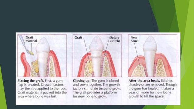 Types of bone and membrane used in guided tissue regeneration | PPTX | Dental Health | Diseases ...