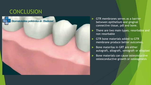 Types of bone and membrane used in guided tissue regeneration | PPTX ...