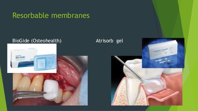 Types of bone and membrane used in guided tissue regeneration