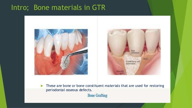 Types of bone and membrane used in guided tissue regeneration