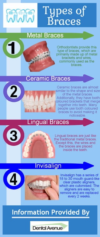 Types of Braces | PDF | Dental Health | Diseases and Conditions