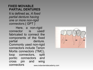 Types of bridges/fixed orthodontics courses | PPT