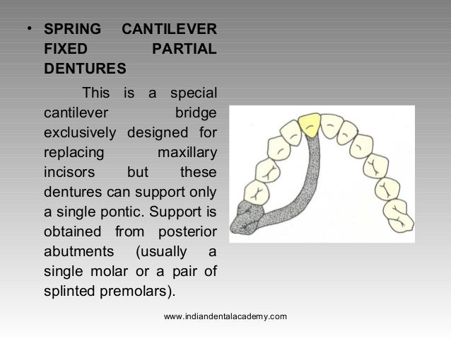 Types of bridges/fixed orthodontics courses
