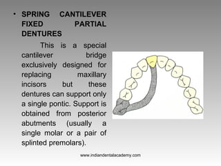 Spring Cantilever Bridge Dental