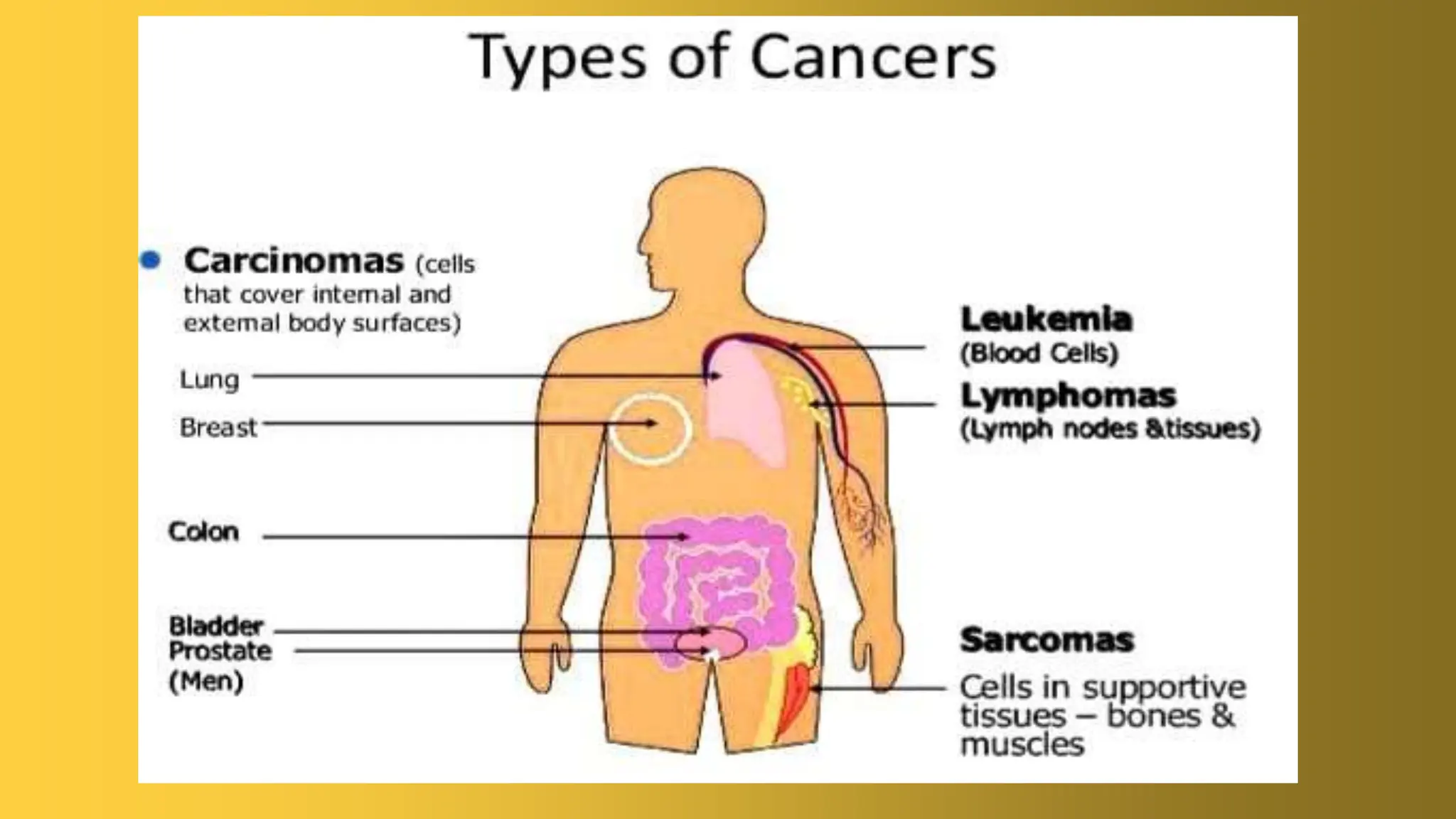 TYPES OF CANCER.pptx