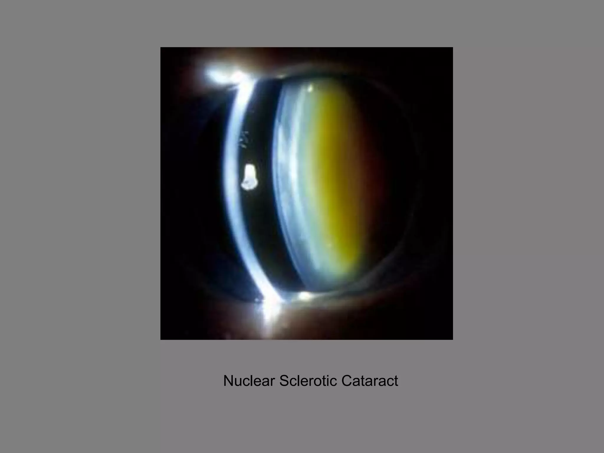 Types of cataract | PPTX | Eye and Vision Conditions | Diseases and ...