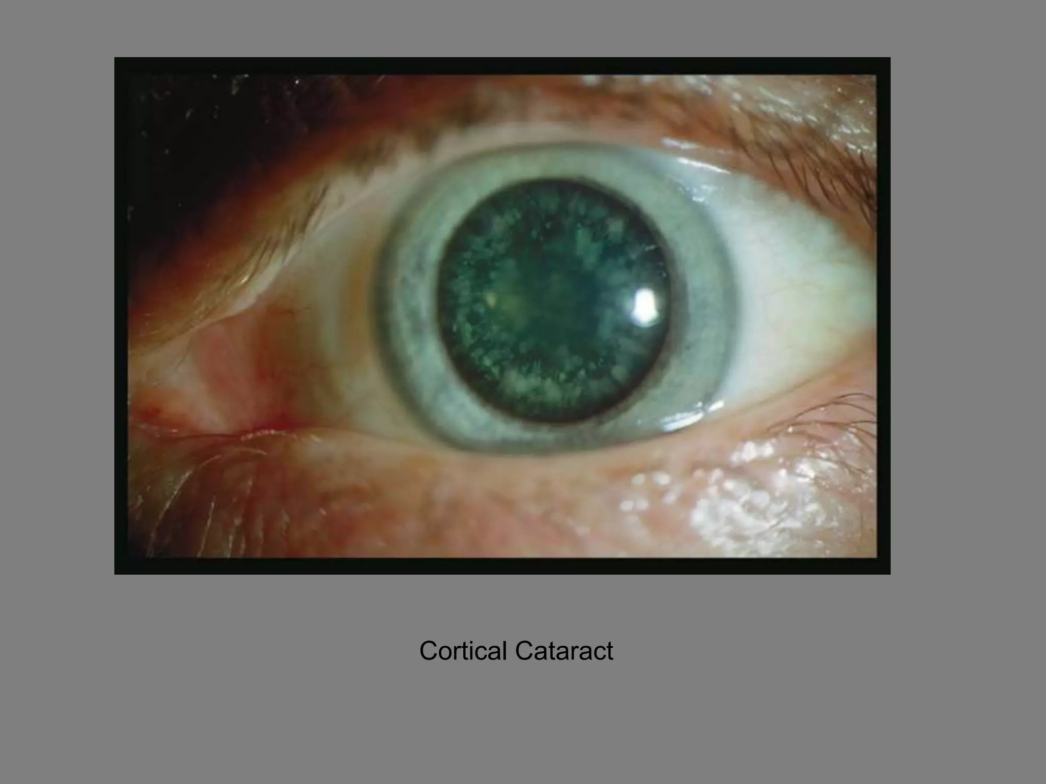 Types of cataract | PPTX | Eye and Vision Conditions | Diseases and ...