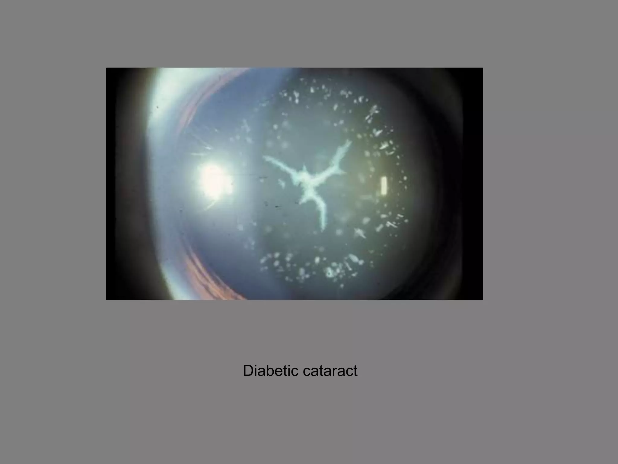 Types of cataract | PPTX | Eye and Vision Conditions | Diseases and ...