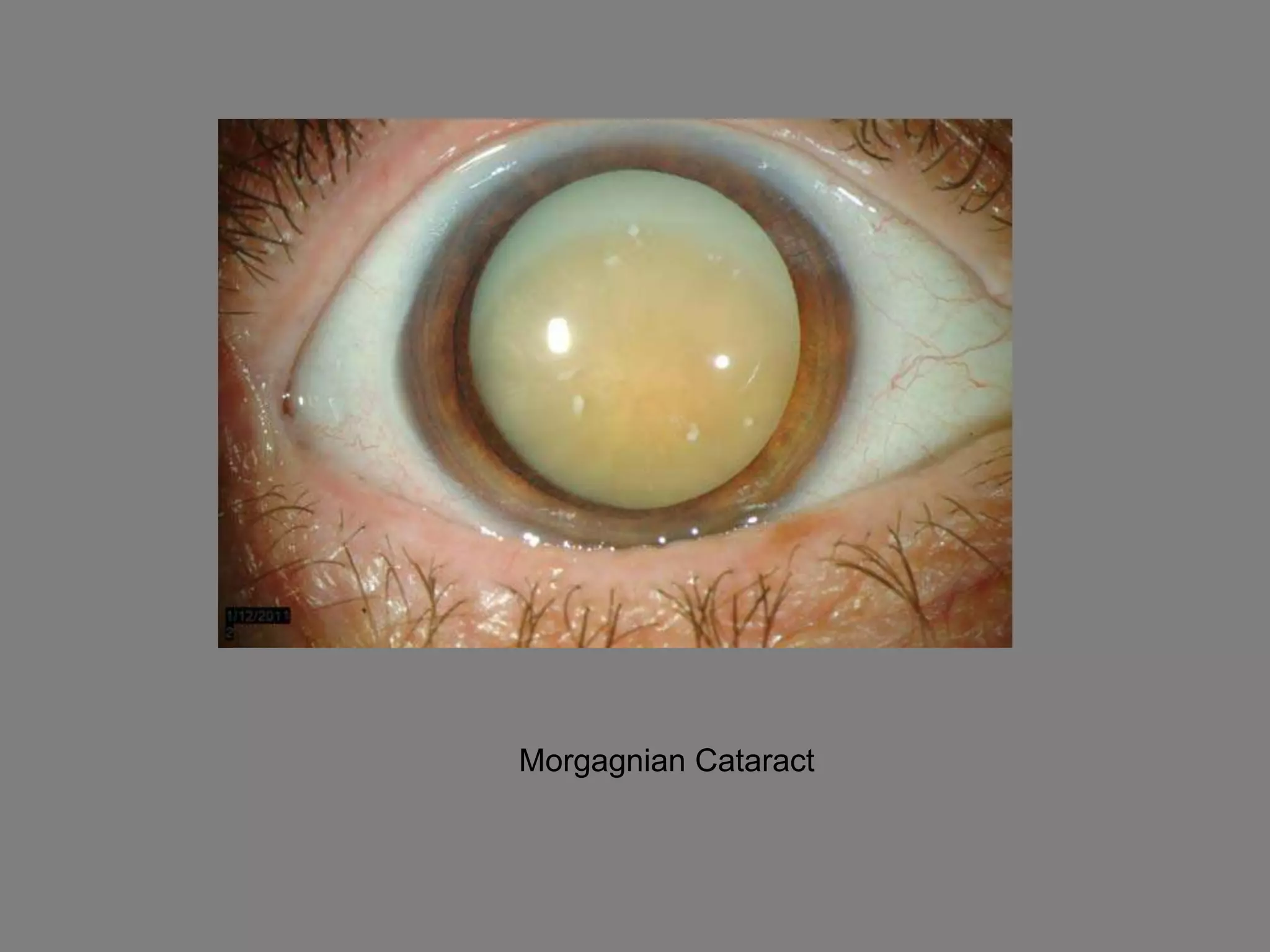 Types of cataract | PPTX