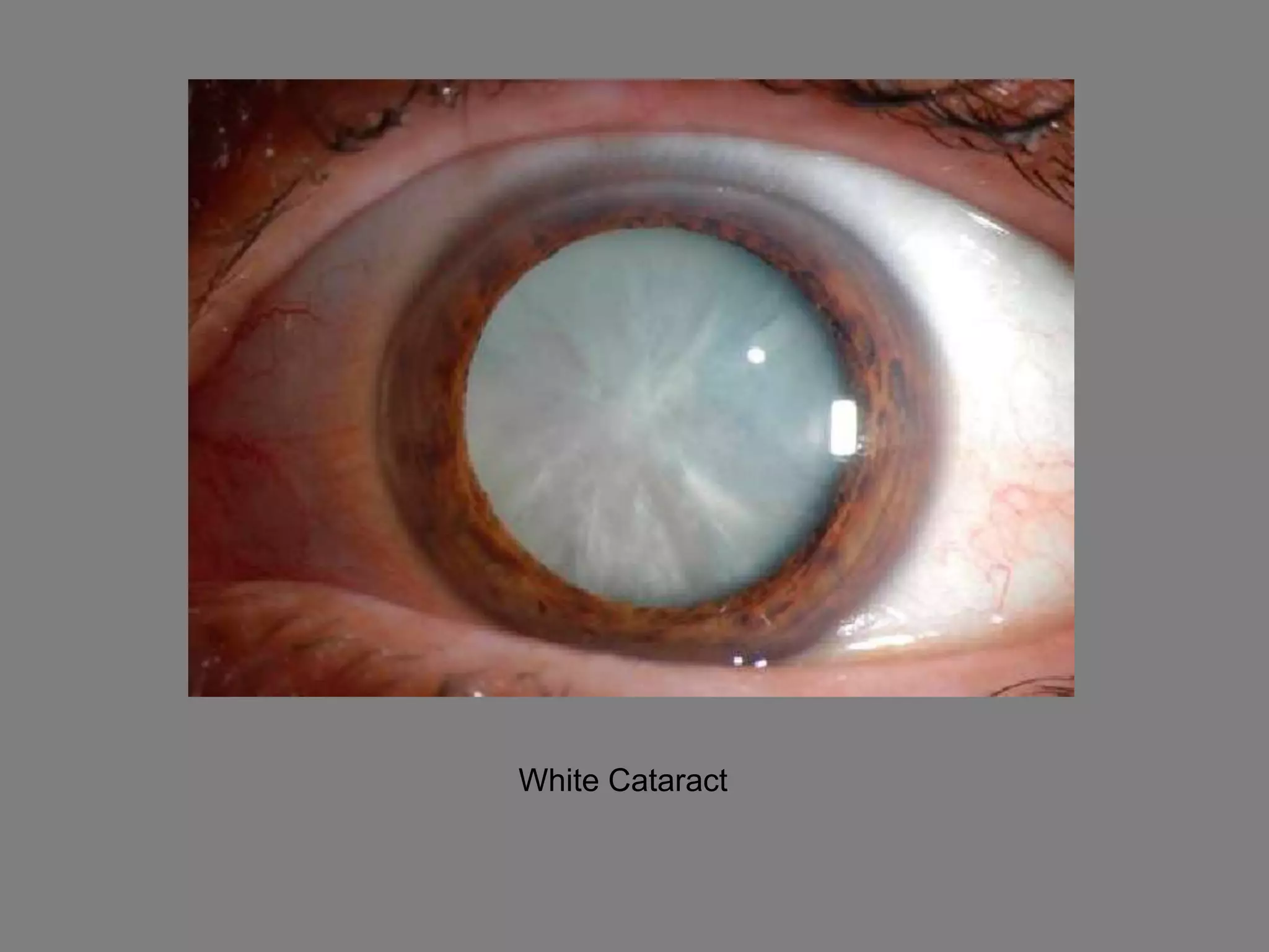 Types of cataract | PPTX