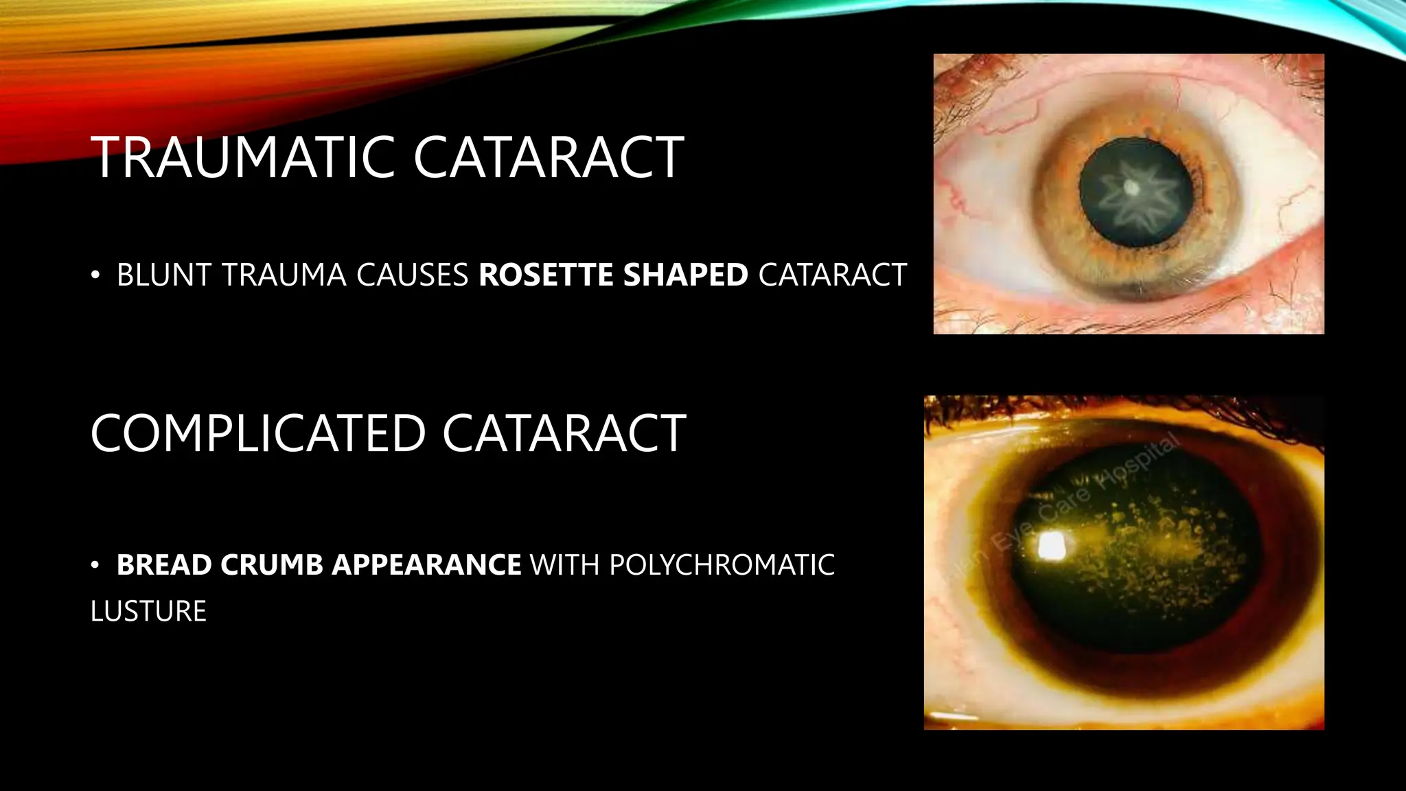 TYPES , SIGNS AND SYMPTOMS OF CATARACT.pptx