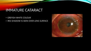 TYPES , SIGNS AND SYMPTOMS OF CATARACT.pptx