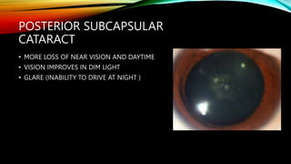 TYPES , SIGNS AND SYMPTOMS OF CATARACT.pptx