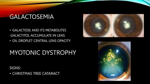 TYPES , SIGNS AND SYMPTOMS OF CATARACT.pptx