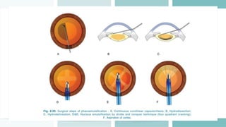 Types of Cataract surgeries.pptx