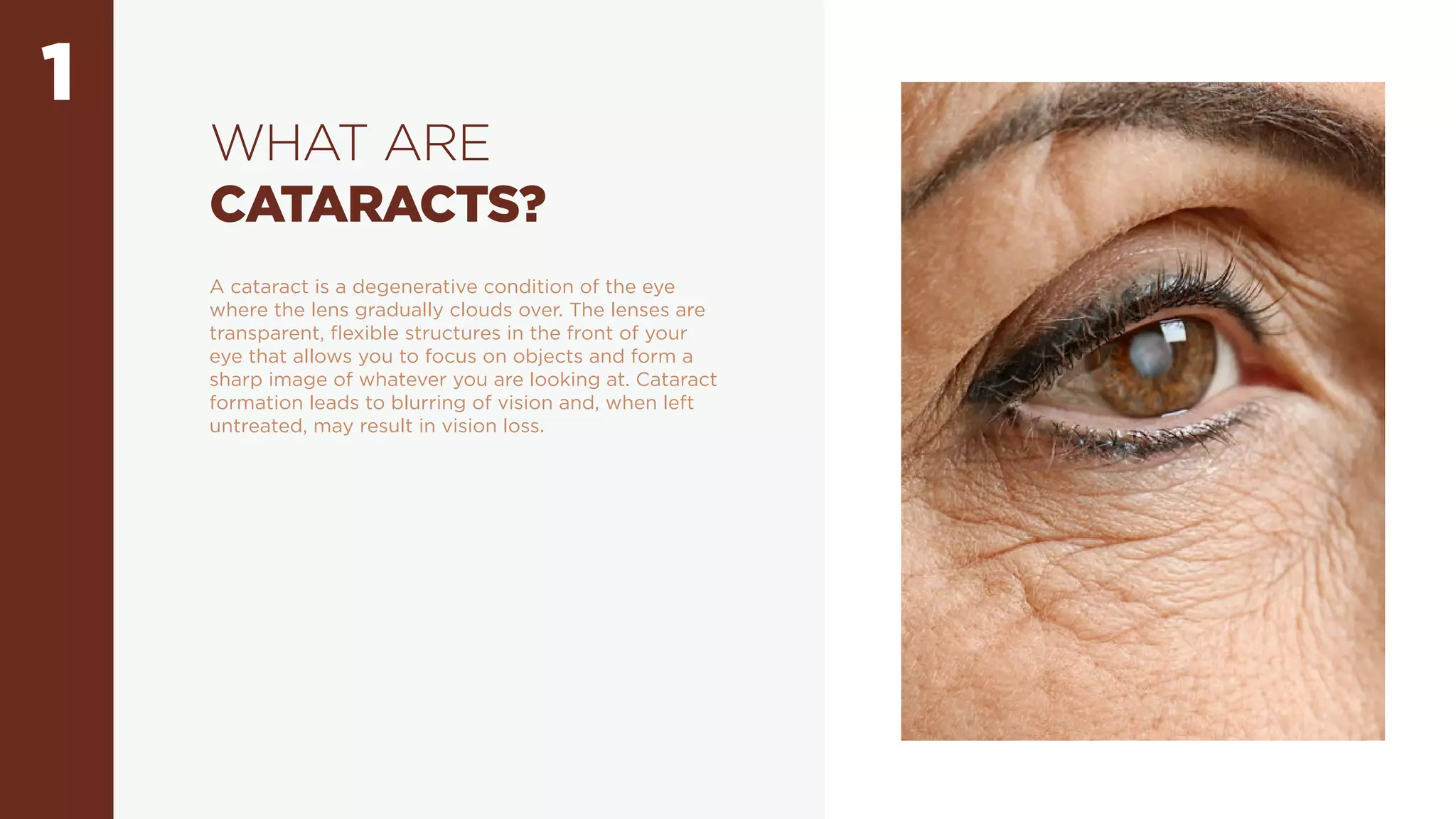 Types of Cataract Surgery.pdf