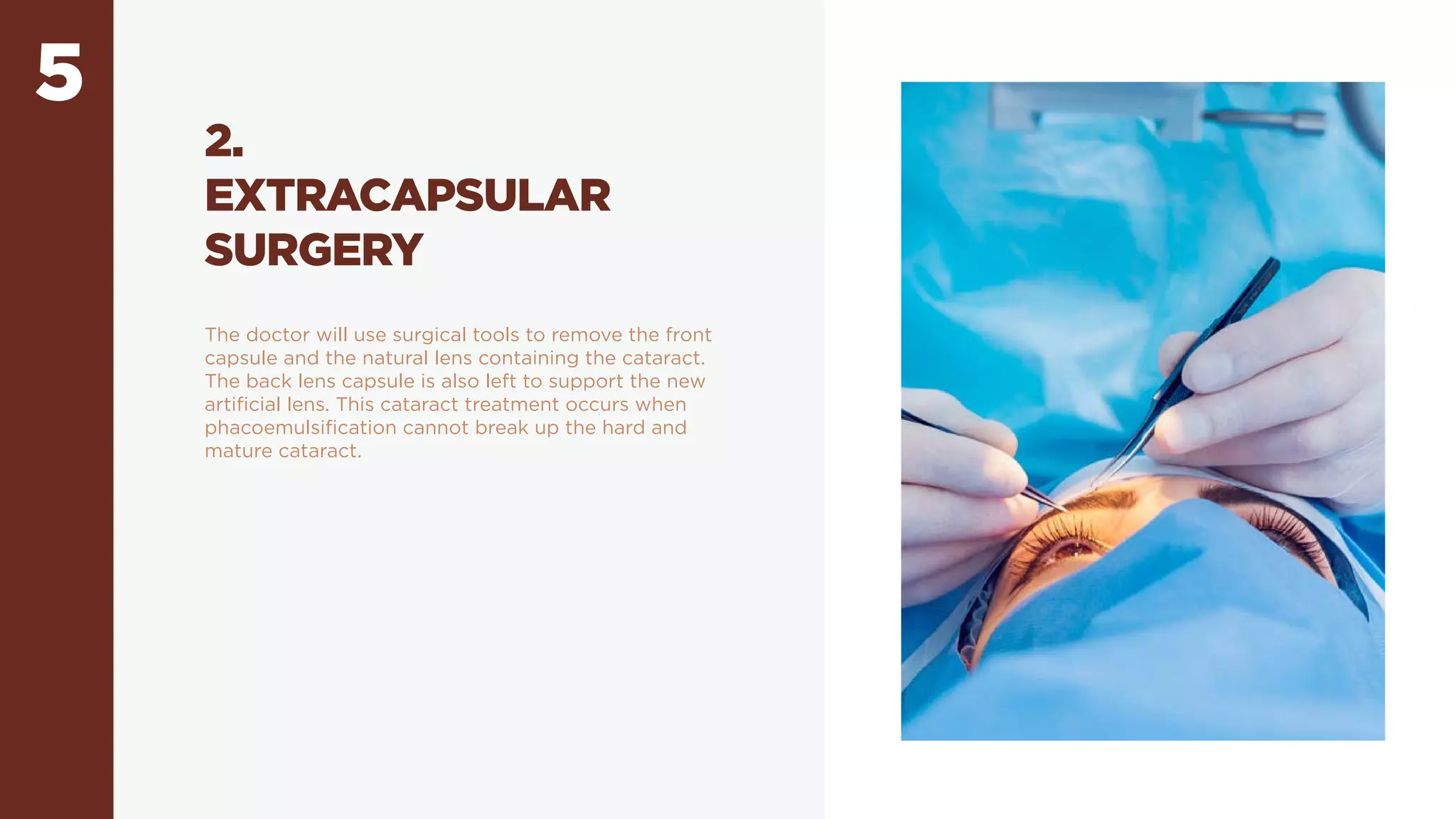 Types of Cataract Surgery.pdf