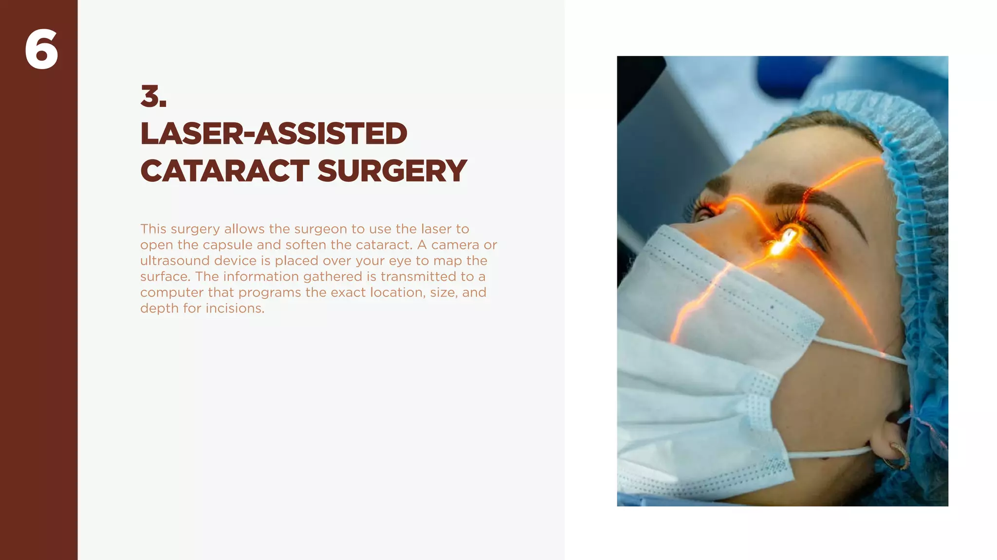 Types of Cataract Surgery.pdf