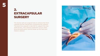 Types of Cataract Surgery.pdf