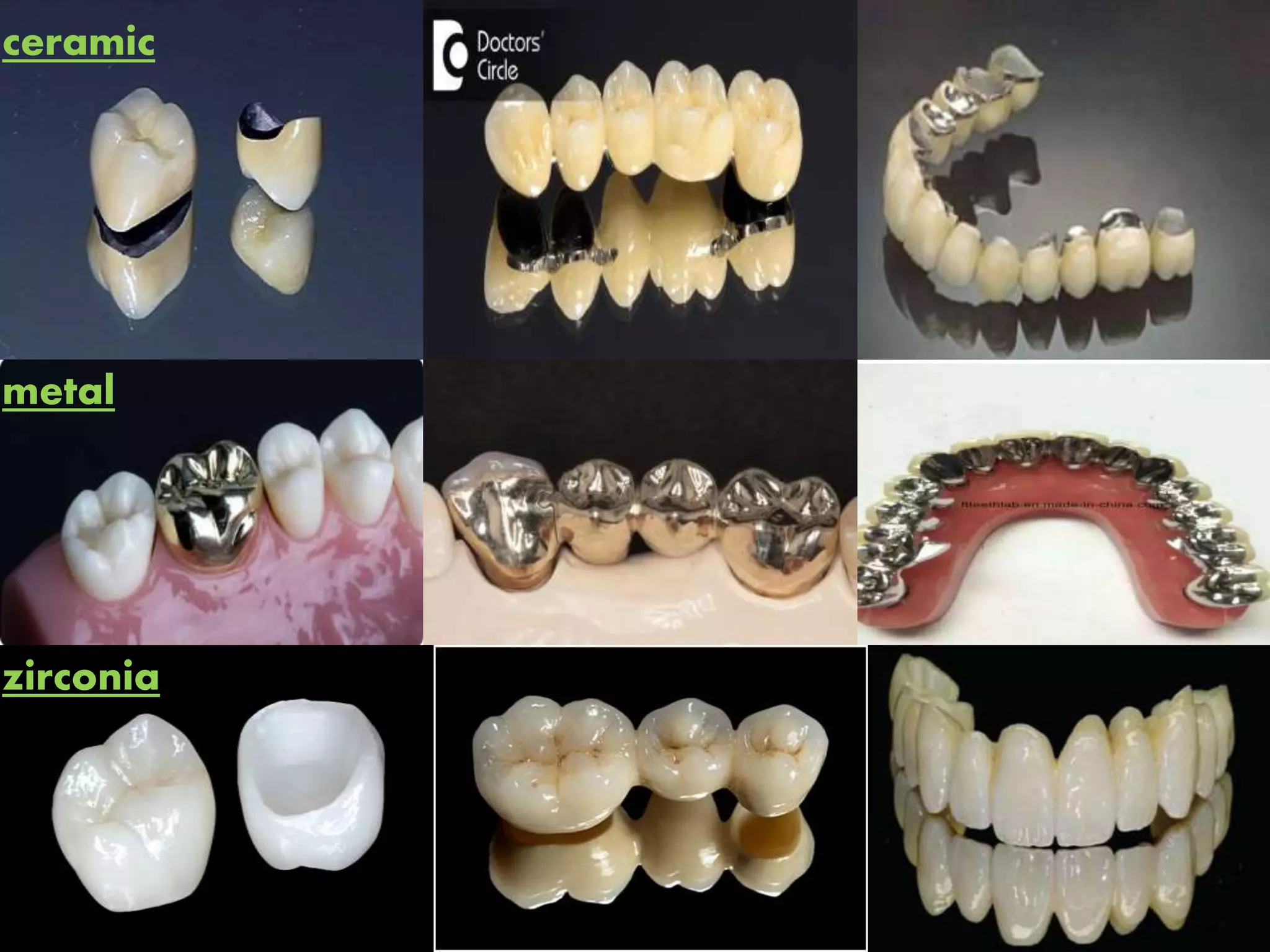 Types of crown | PPT
