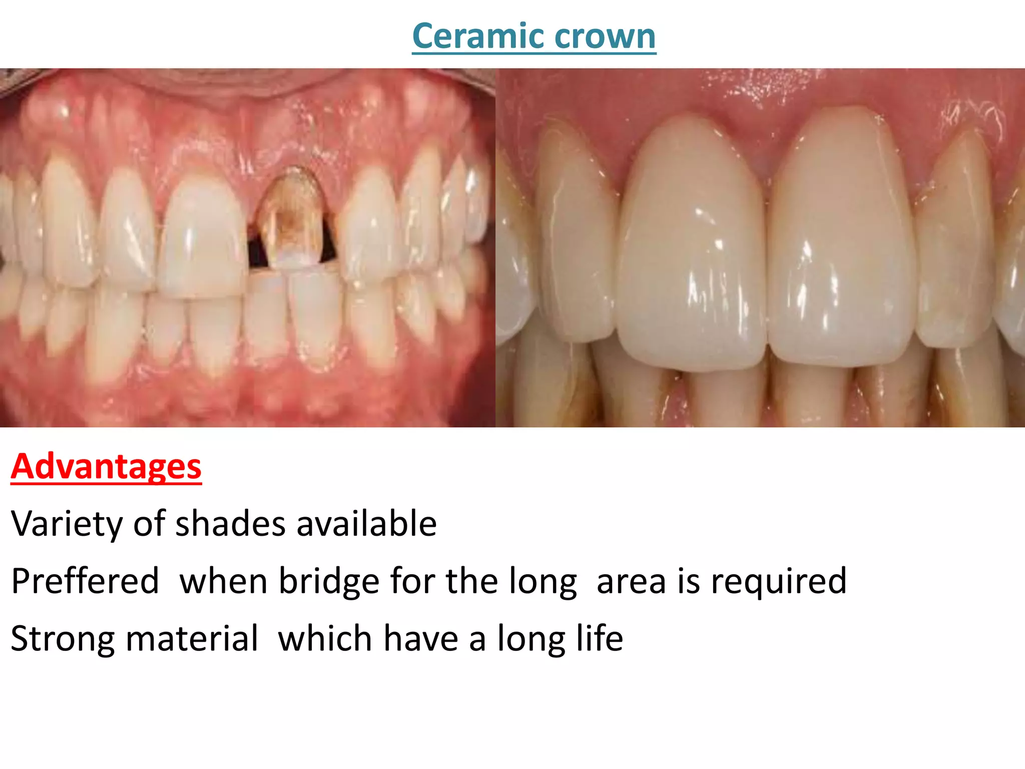 Types of crown | PPT