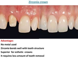 Types of crown | PPT