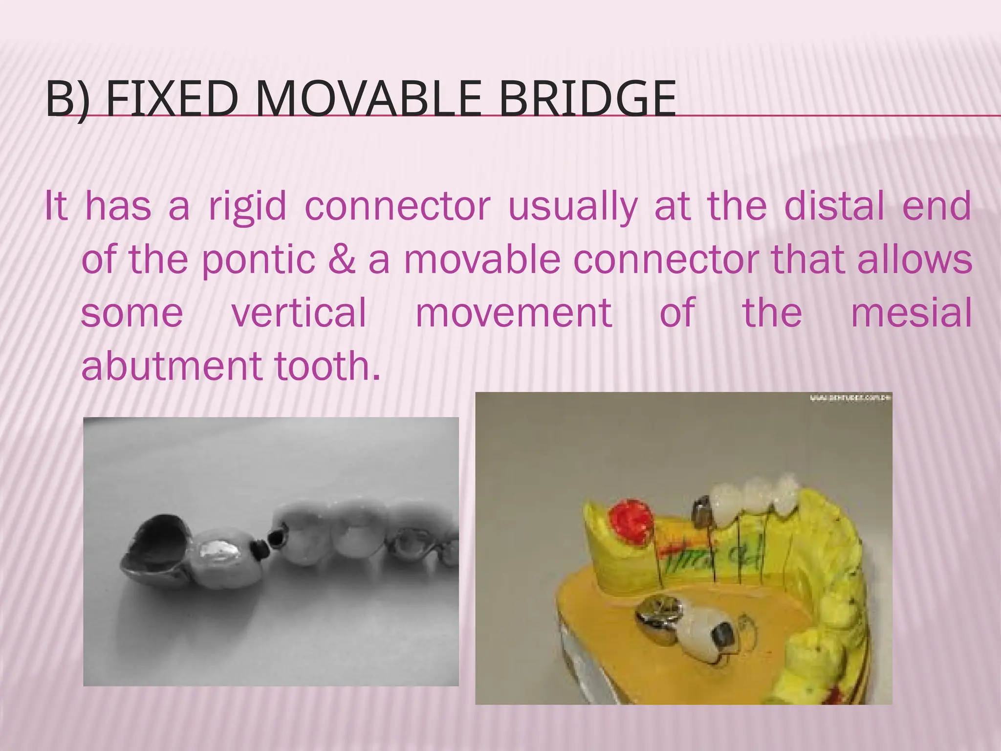 Types of special crownsand bridges in FPD | PPTX