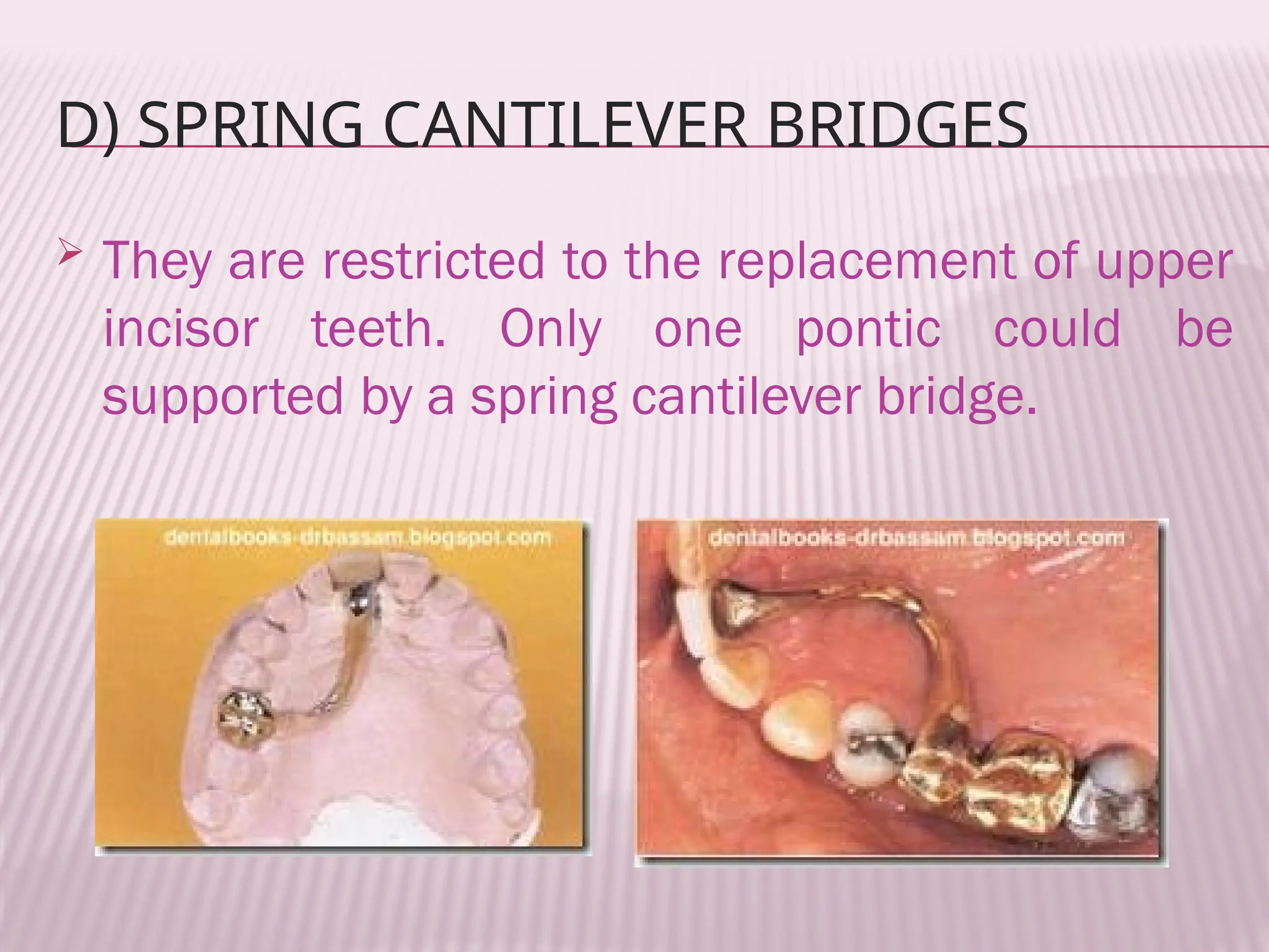 Types of special crownsand bridges in FPD | PPTX