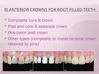 Types of special crownsand bridges in FPD | PPTX