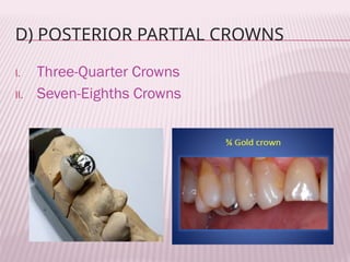 Types of special crownsand bridges in FPD | PPTX