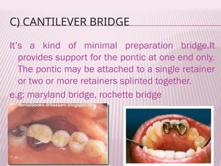 Types of special crownsand bridges in FPD | PPTX