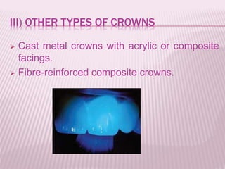 Types of crown & bridges | PPTX
