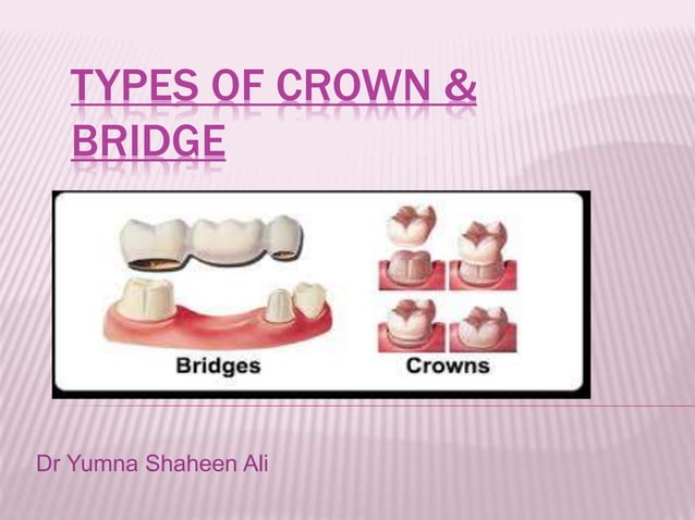 Types of crown & bridges | PPTX | Oral care | Personal Care