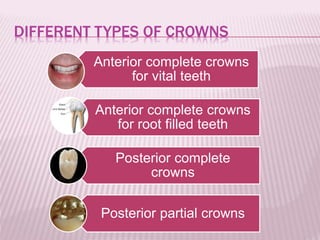 Types of crown & bridges | PPTX