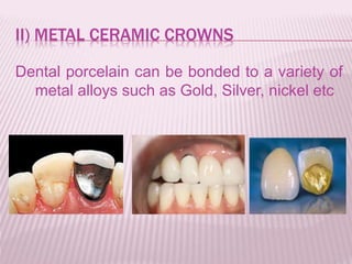 Types of crown & bridges | PPT