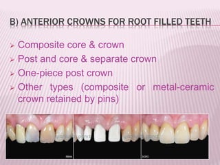 Types of crown & bridges | PPT