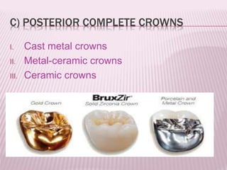 Types of crown & bridges | PPT