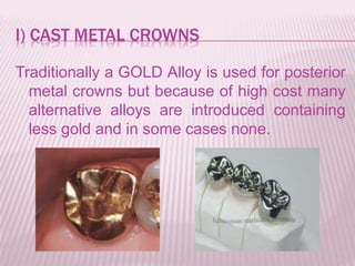 Types of crown & bridges | PPT