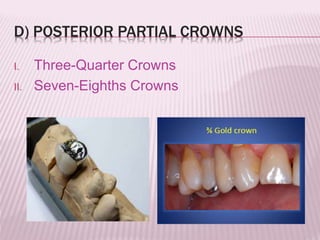 Types of crown & bridges | PPT
